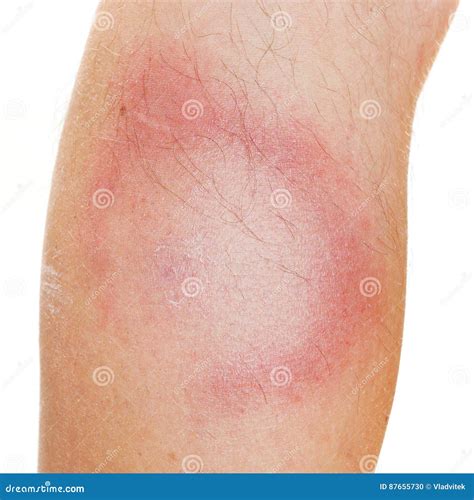Erythema Migrans Rash Stock Images By Megapixl