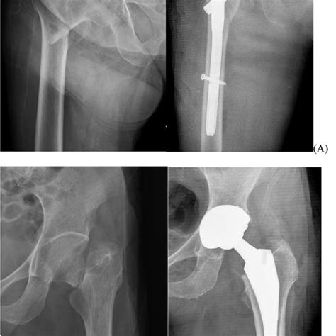 A 54 Year Old Woman With An Osteoporotic Compression Fracture At L3 Download Scientific Diagram