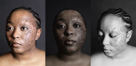 Beauty Of Burn Survivors Elyse Rianna Mansfield Ual Showcase