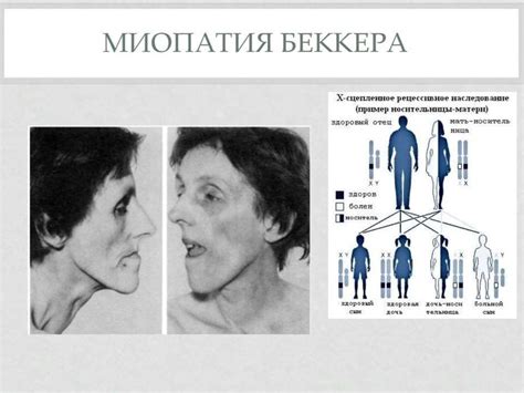 Прогрессирующие мышечные дистрофии Дюшенна и Бекера презентация онлайн