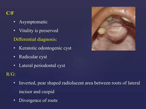 Fissural Cysts Of Oral Cavity Pptx