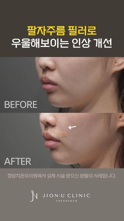 팔자주름 필러로 우울한 인상 개선하기🙌 팔자필러 팔자주름 팔자필러후기 필러전후 필러후기 Koreanclinic Seoulclinic Youtube