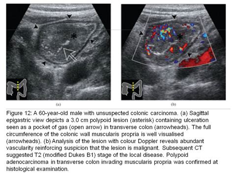BÀi SoẠn VỀ SiÊu Âm ChẨn ĐoÁn Colonic Polyps Us Detection