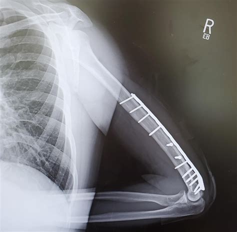 Distal Humerus Fracture 20wk Post Orif Surgery R Brokenbones