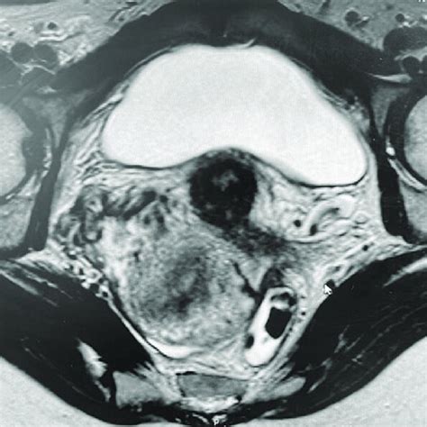 Preoperative Magnetic Resonance Imaging Download Scientific Diagram