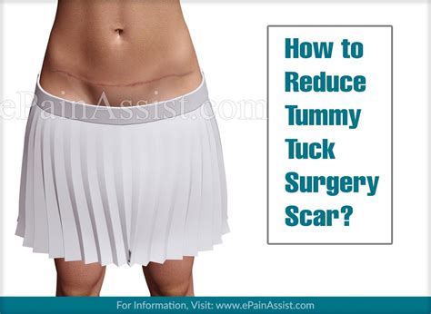 How To Reduce Tummy Tuck Surgery Scar