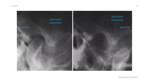 Tmj Imaging Pptx