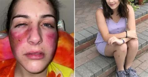 “웃거나 울면 얼굴에 끔찍한 고통이 ” 원인은