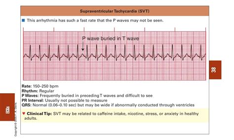 Svt Sinus Tach Ecg Tachycardia Supraventricular Atrial Clues Avnrt Avrt