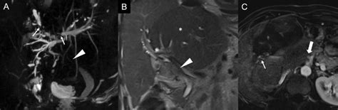 Ischemic Cholangiopathy In The Setting Of Chronic Hepatic Artery