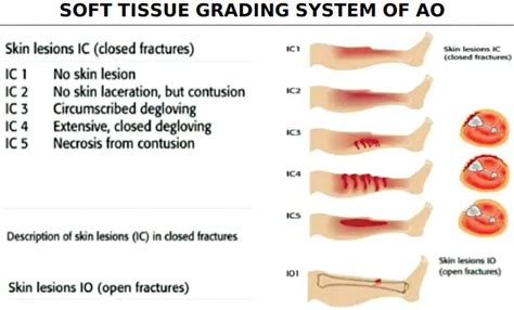 Soft Tissue Vs Deep Tissue Injury At Leon Donovan Blog