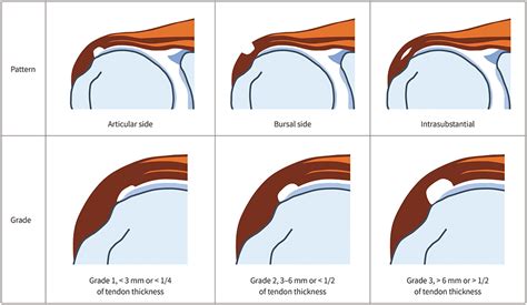 Rotator Cuff Tear Grade 1 At Arthur Snipes Blog