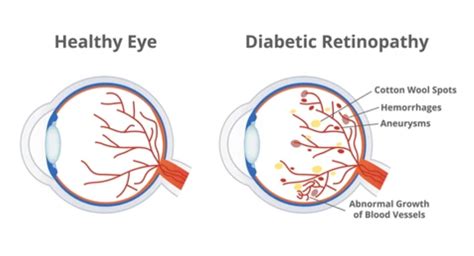 Diabetic Retinopathy Disease Smart Laser Eye Center
