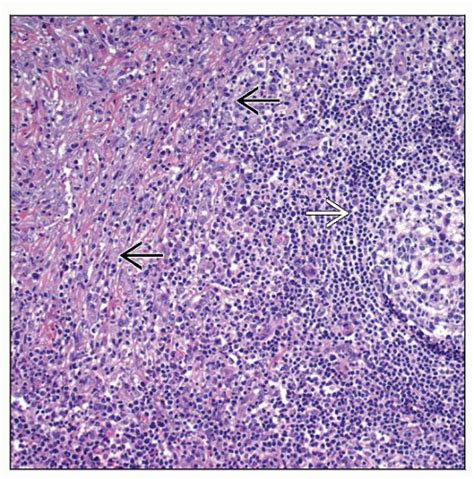 Inflammatory Pseudotumor Basicmedical Key