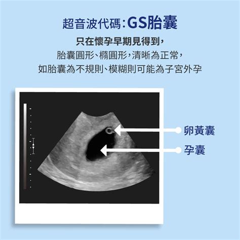孕媽不再霧煞煞讓您快速看懂產檢超音波照的英文代碼 Mamaway