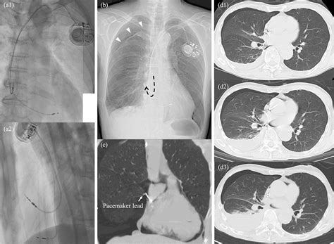 Complete Atrial Screw Lead Penetration And Contralateral Pneumothorax
