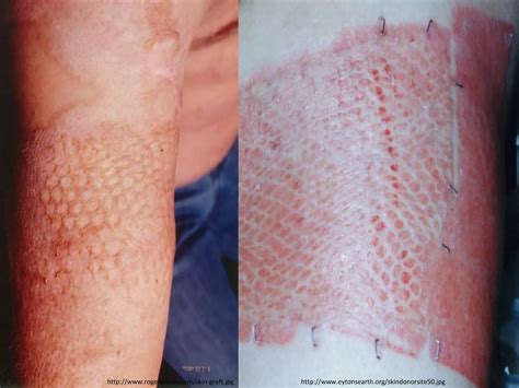 Skin Graft Ppt