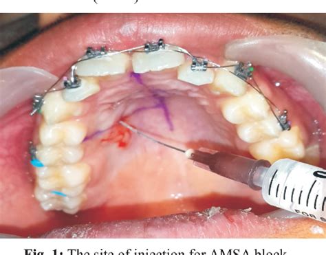 Figure 5 From Anaesthetic Efficacy Of The Anterior Middle Superior