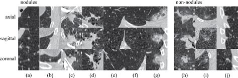 Figure 1 From Pulmonary Nodule Detection In Ct Images False Positive