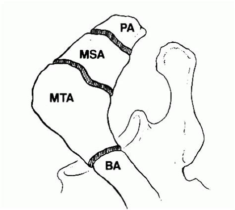 The Treatment Of The Symptomatic Os Acromiale Musculoskeletal Key