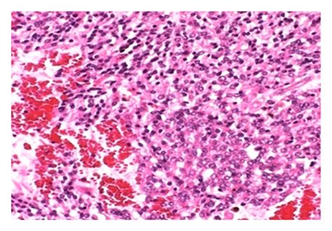 The Distinction Between Epithelioid Type Lower Side Right And Spindle Download Scientific