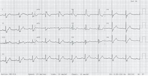 Bifascicular Block Rcemlearning India