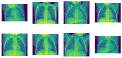 Pneumonia Detection Using Cnn In Python Geeksforgeeks
