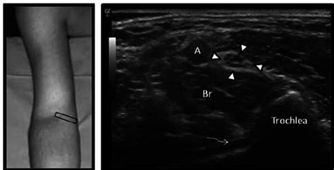 A Diagram Is Provided Of The Antecubital Fossa And The Associated