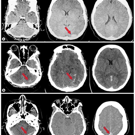 A Initial Plain Ct Of The Brain Showing The Hyperdensity Within The