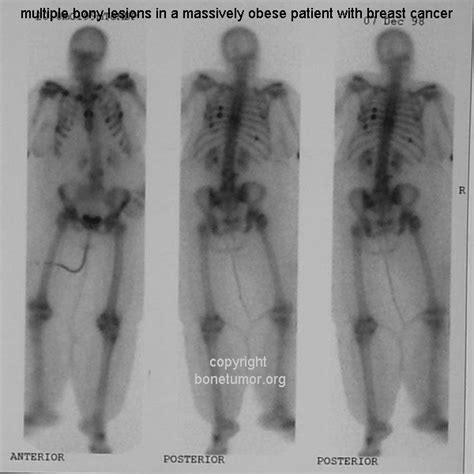 Metastatic Breast Cancer