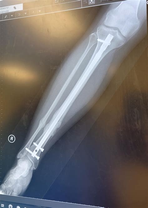 Tibia Fibula Orif Neat Healed Pics R Orif