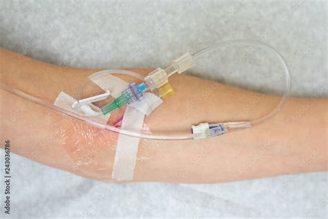 Babe Adult Female Arm With Intravenous Injection At The Emergency Room Stock Photo Adobe Stock
