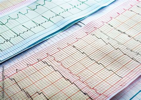 Fényképezés Electrocardiogram Ecg Printouts Showing Various Abnormal
