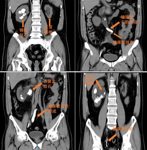 【广西医院】中山一院广西医院应用新型一体位下“双镜联合”手术治疗复杂性尿路结石患者 中山大学附属第一医院