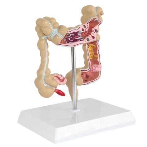 Human Colorectal Lesion Model Anatomical Model Human Colon Learning Supplies Tool Medical
