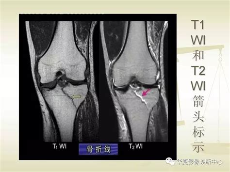 22种骨关节基本病变的mri表现 好医术文章 好医术 赋能医生守护生命