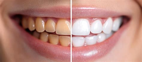 Before And After Teeth Whitening Comparison Showing Yellow And White