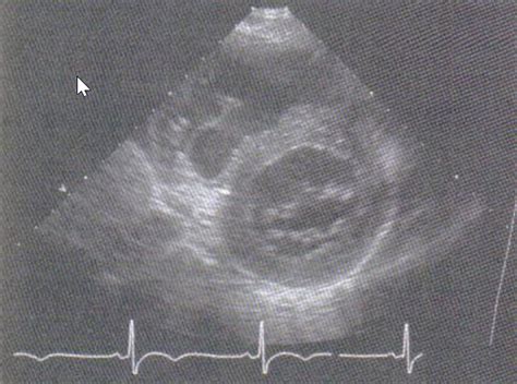 Psax At The Mv Diagram Quizlet