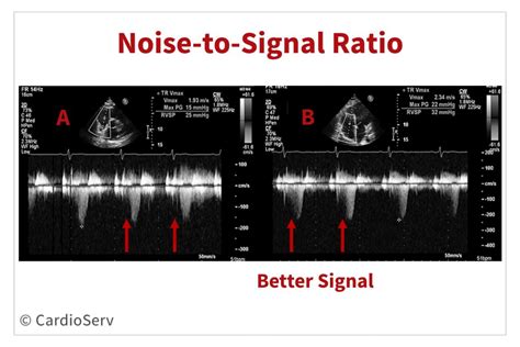 2 Ways To Properly Assess TR Jets For Accurate RVSP Calculations Cardioserv