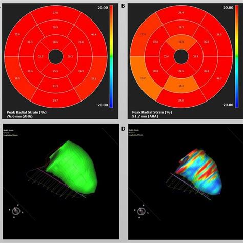 Strain Analysis Using Feature Tracking In A Patient Undergoing Download Scientific Diagram