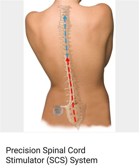 Are Spinal Cord Stimulators Worth The Risk Artofit