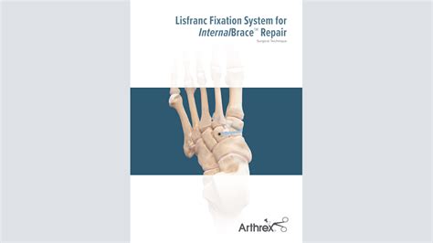 Arthrex Internalbrace™ Procedure For Brostrom Repair