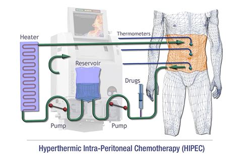 腹腔热灌注疗法HIPEC 广州复大肿瘤医院