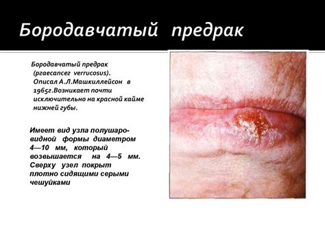 Предраковые заболевания слизистой оболочки рта и красной каймы губ презентация онлайн