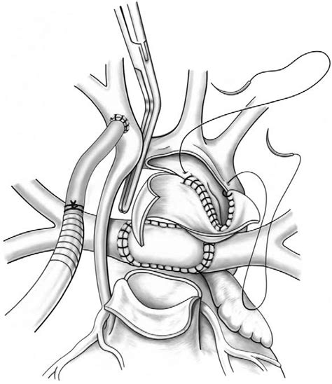 Reconstruction Of The Pulmonary Bifurcation Using An Autologous Download Scientific Diagram
