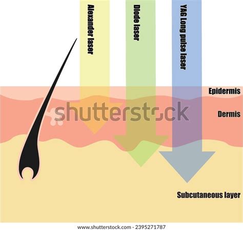 Differences Hair Removal Lasers Seen Crosssectional Stock Vector Royalty Free 2395271787