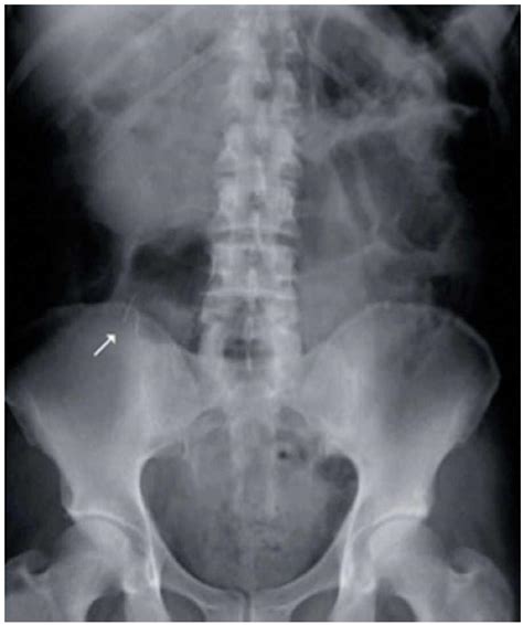 Filexray Showing Fecalith Which Has Caused Appendicitis