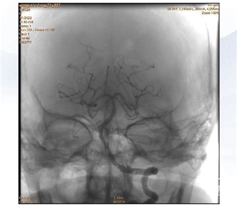 心玮•藏经阁 左侧椎动脉v4段夹层动脉瘤合并狭窄血流导向装置植入 脑医汇 神外资讯 神介资讯