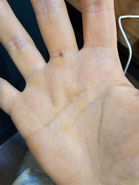 안녕하세요 피부 검은색점에대해서 질문드립니다 지식in