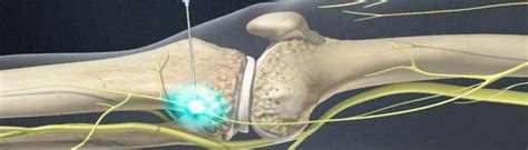 Novel Method Of Using Proximal Femoral Triangle And Intermediate
